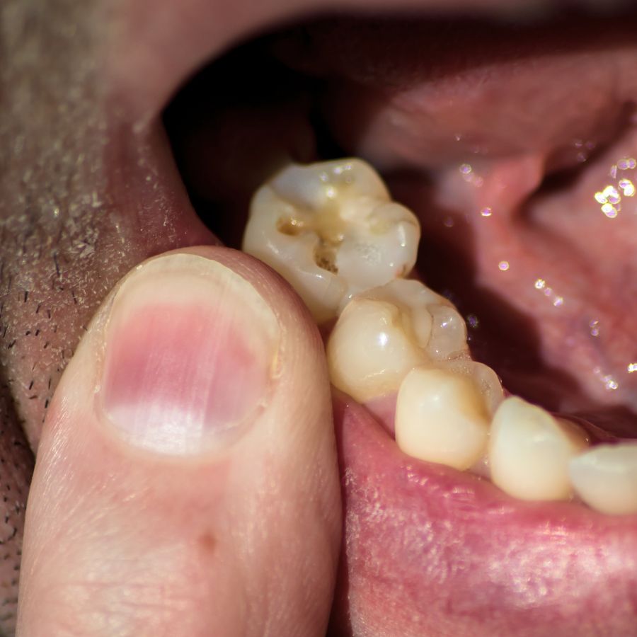 Signs and Symptoms of Tooth Abscess : Stages of a Tooth Abscess