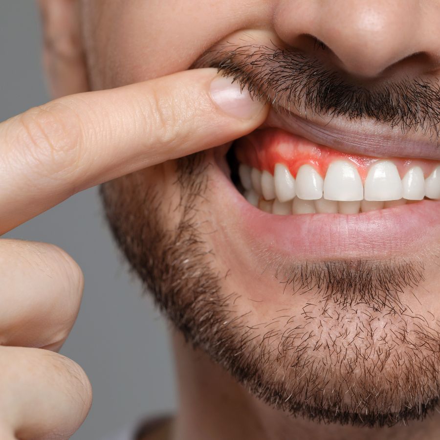 Signs and Symptoms of Tooth Abscess : Stages of a Tooth Abscess